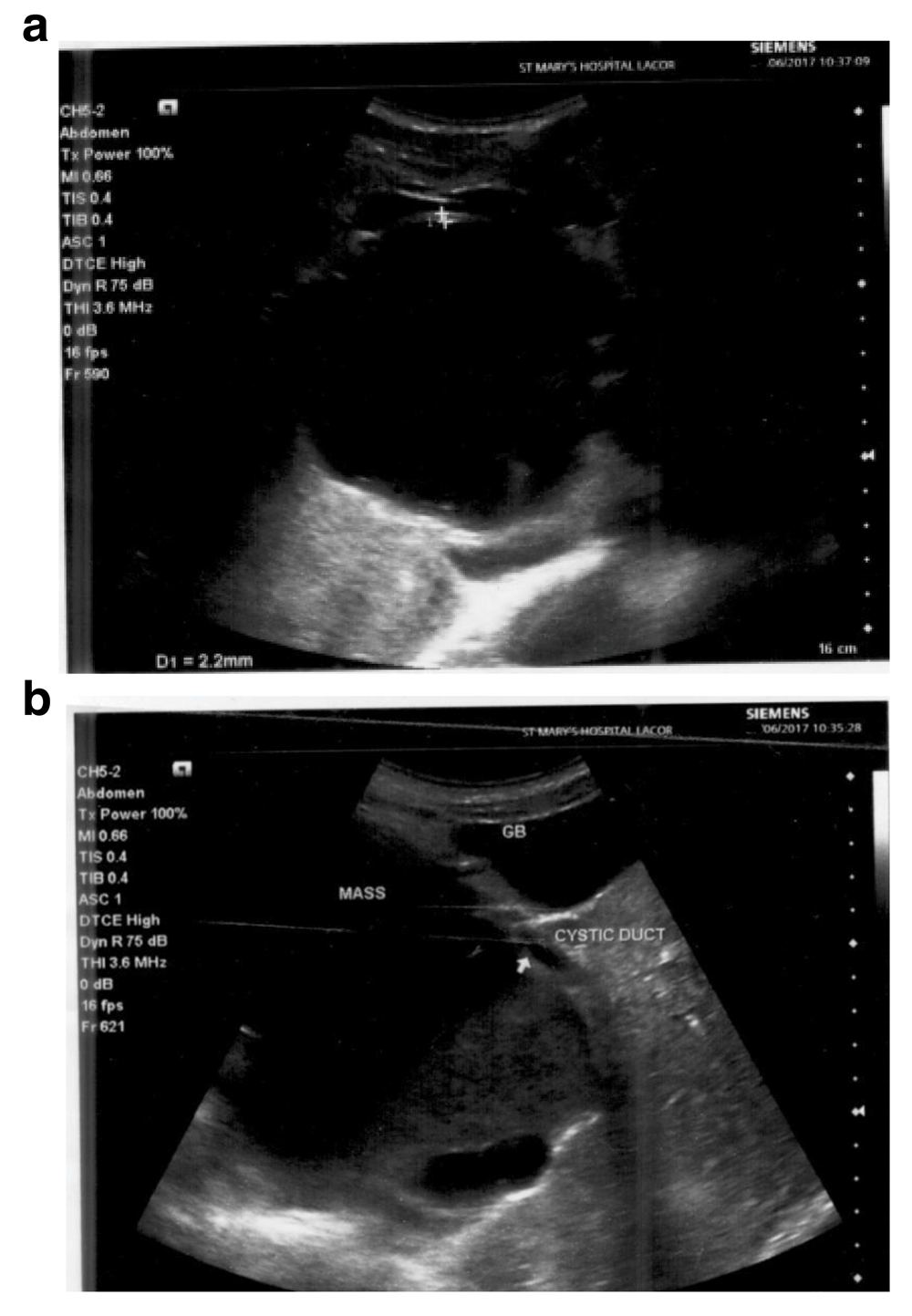 Case Report: Biloma gastrostomy after failed... | Open Research Africa